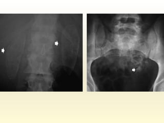 Nephrocalcinosis | PPTX