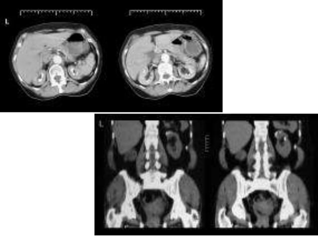 Nephrocalcinosis | PPTX | Medical Tests | Medical Health