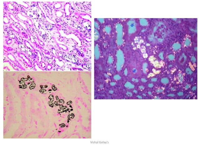 Nephrocalcinosis | PPTX | Medical Tests | Medical Health