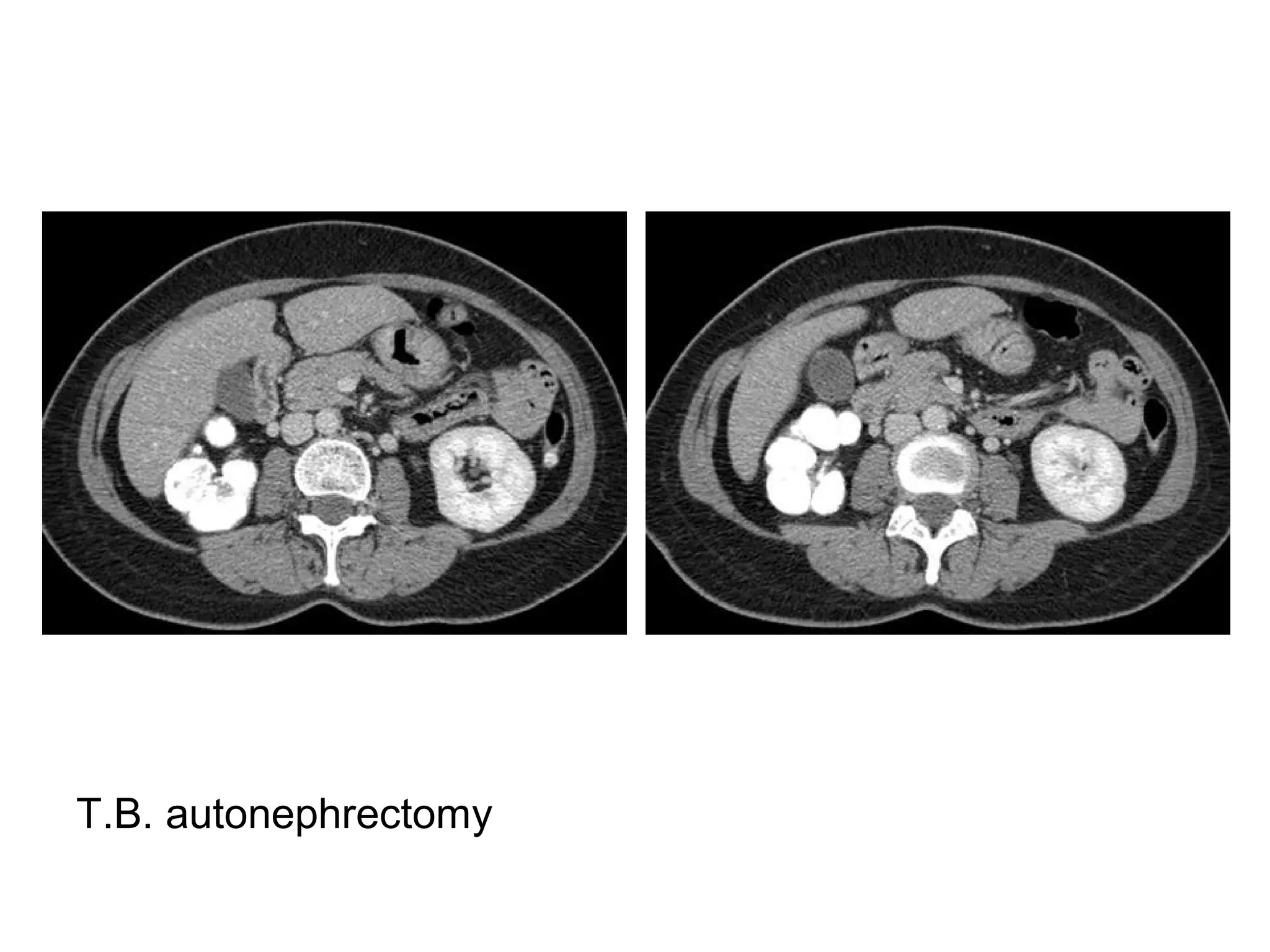 Diagnotic Imaging of Nephrocalcinosis | PPT