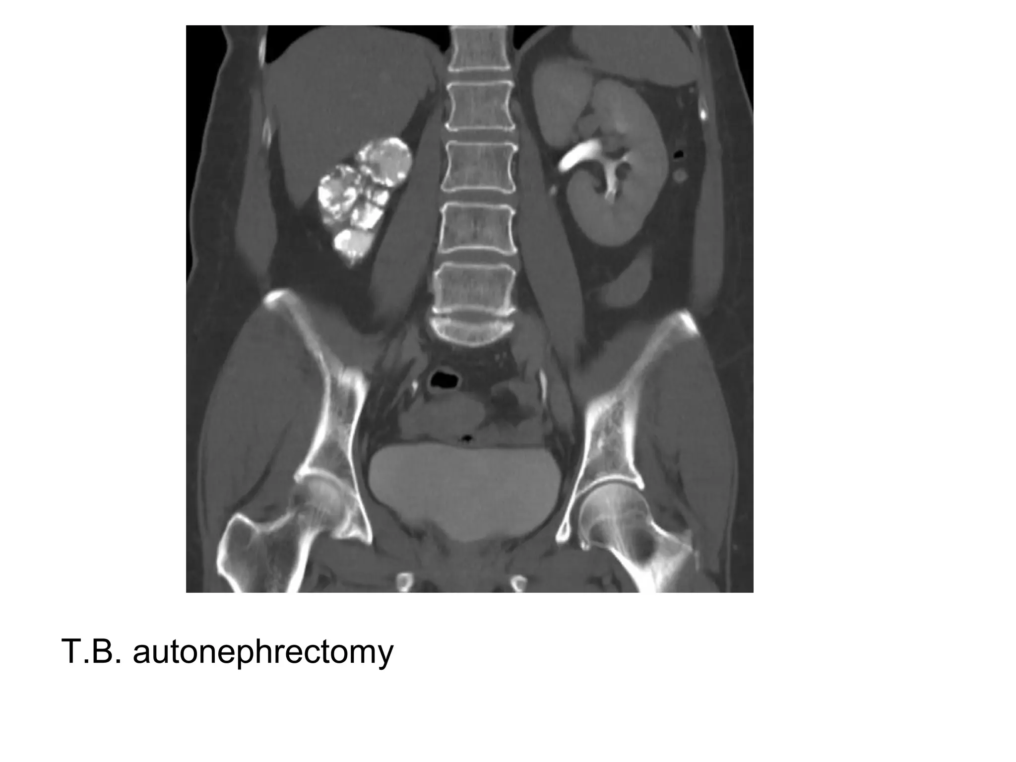 Diagnotic Imaging of Nephrocalcinosis | PPT