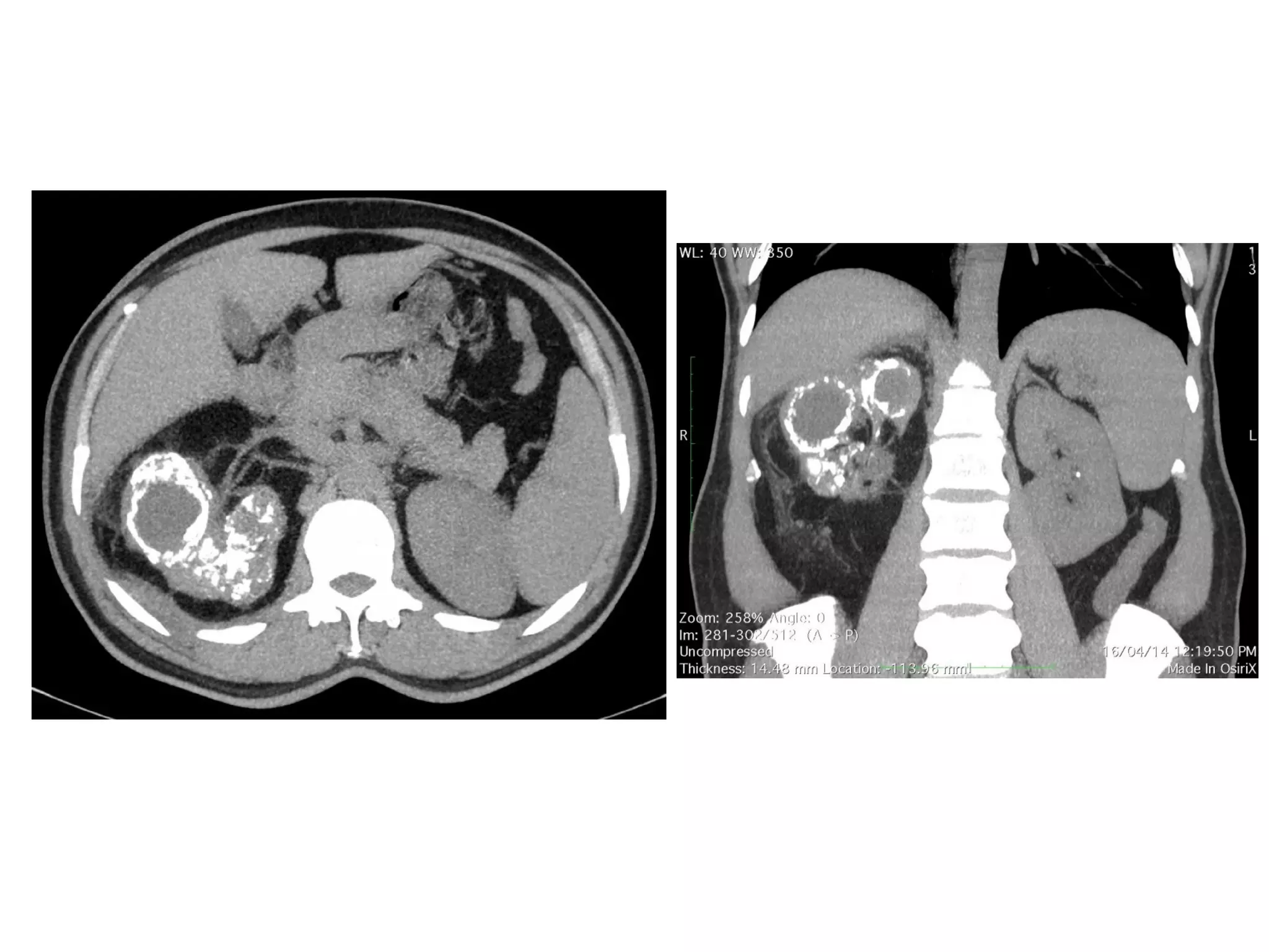 Diagnotic Imaging of Nephrocalcinosis | PPT
