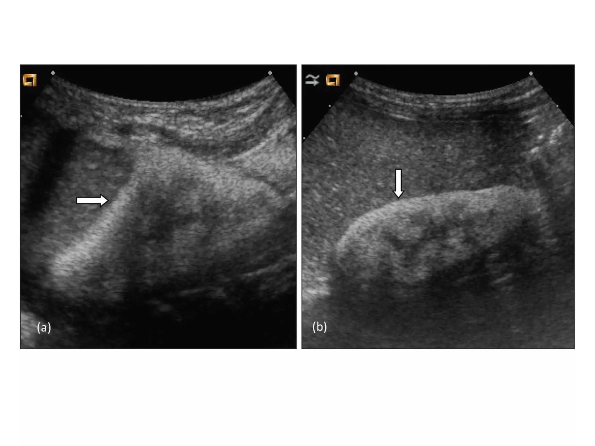 Diagnotic Imaging of Nephrocalcinosis | PPT