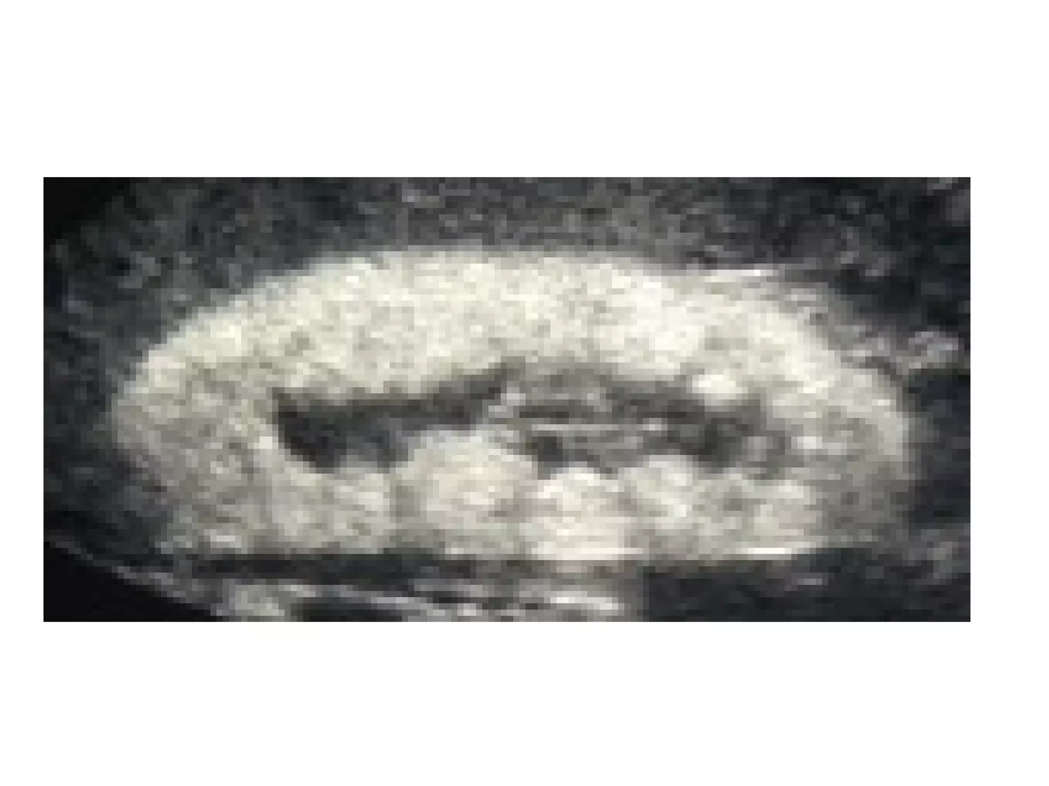 Diagnotic Imaging of Nephrocalcinosis | PPT