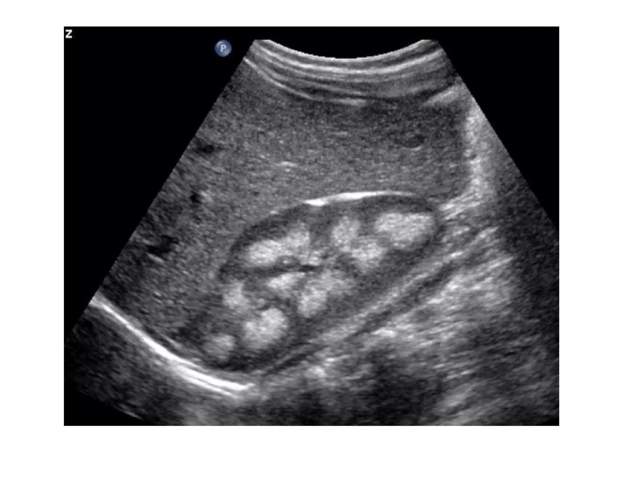 Diagnotic Imaging of Nephrocalcinosis | PPT