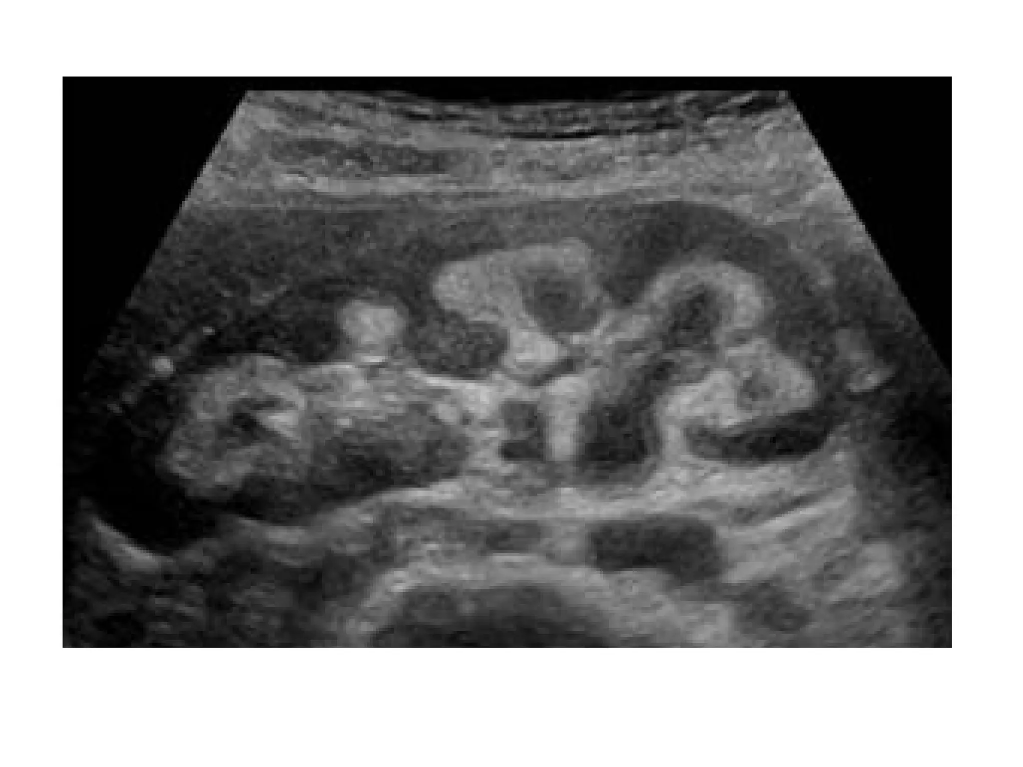 Diagnotic Imaging of Nephrocalcinosis | PPT