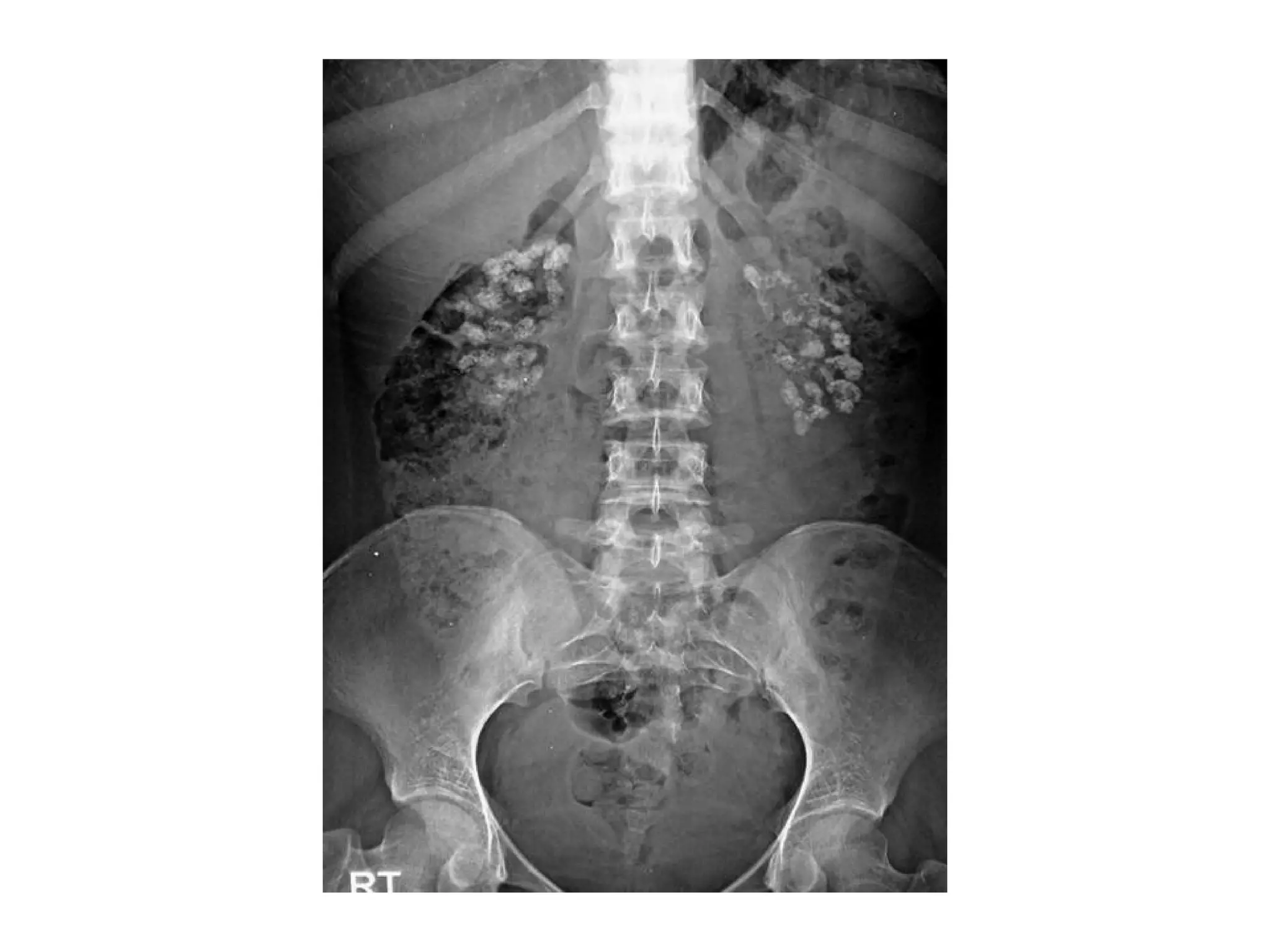 Diagnotic Imaging of Nephrocalcinosis | PPT