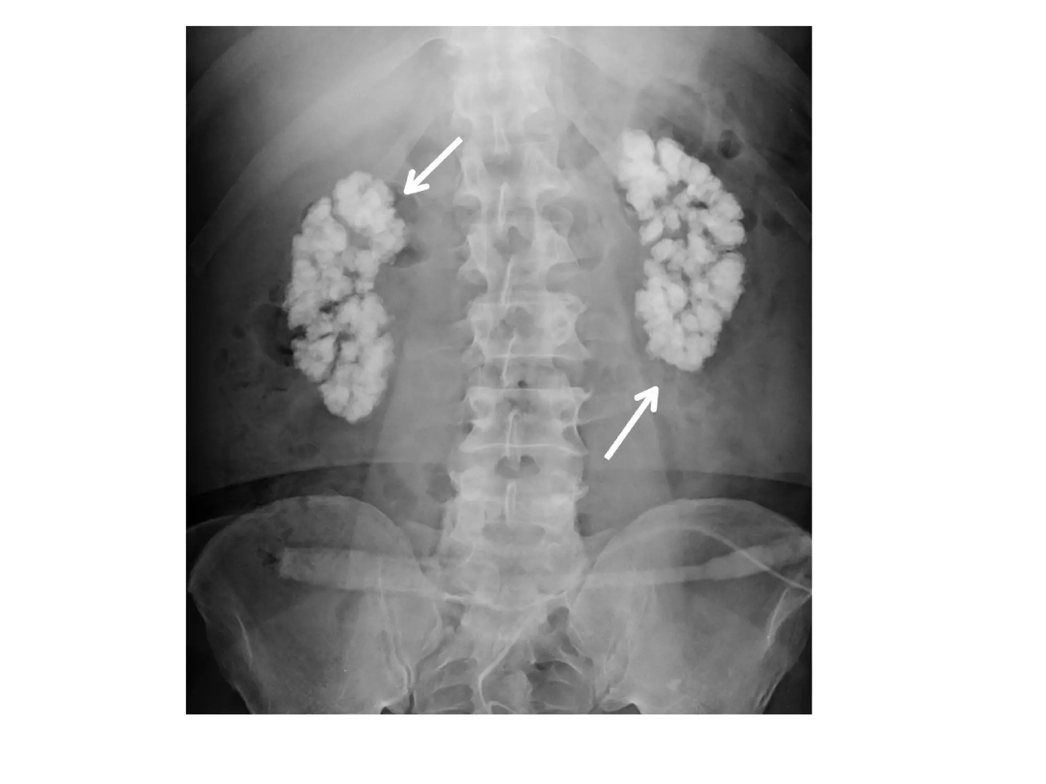 Diagnotic Imaging of Nephrocalcinosis | PPT