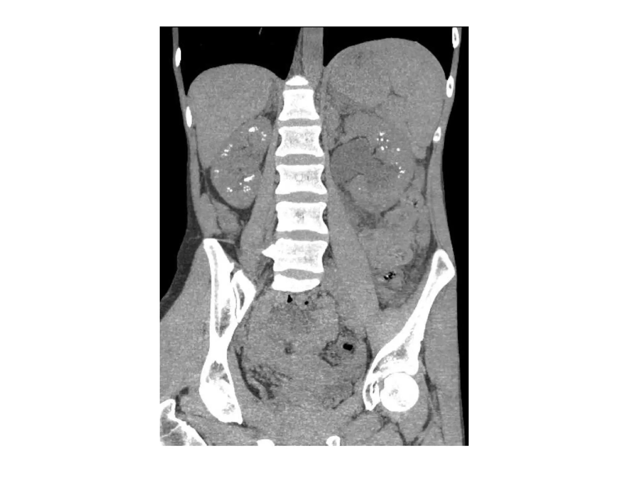 Diagnotic Imaging of Nephrocalcinosis | PPT
