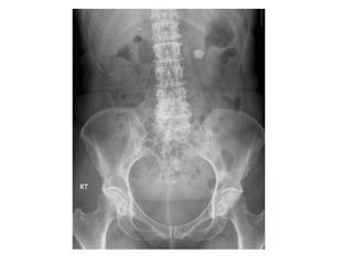 Diagnotic Imaging of Nephrocalcinosis | PPT