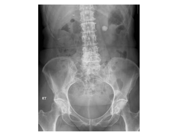 Diagnotic Imaging of Nephrocalcinosis | PPT
