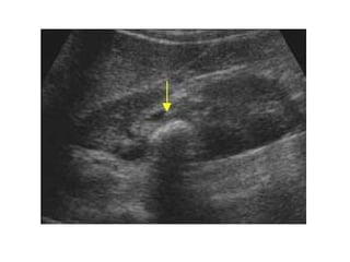 Diagnotic Imaging of Nephrocalcinosis | PPT