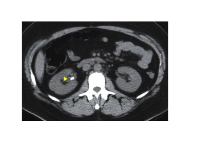 Diagnotic Imaging of Nephrocalcinosis | PPT