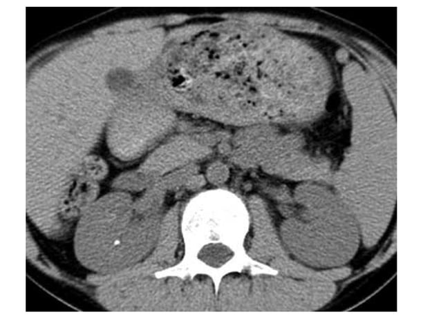 Diagnotic Imaging of Nephrocalcinosis | PPT