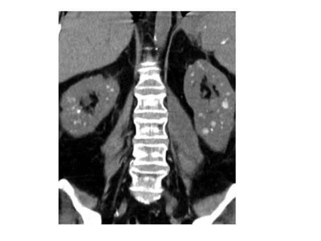 Diagnotic Imaging of Nephrocalcinosis | PPT