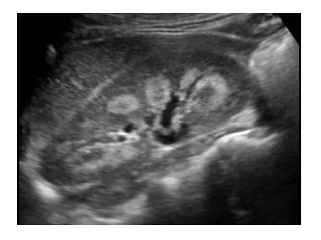Diagnotic Imaging of Nephrocalcinosis | PPT