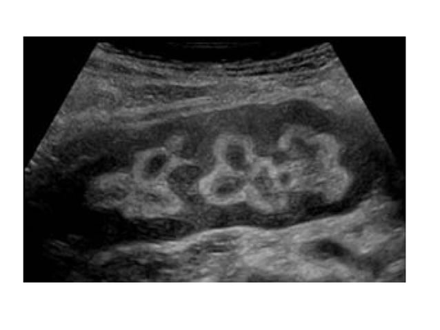 Diagnotic Imaging of Nephrocalcinosis | PPT