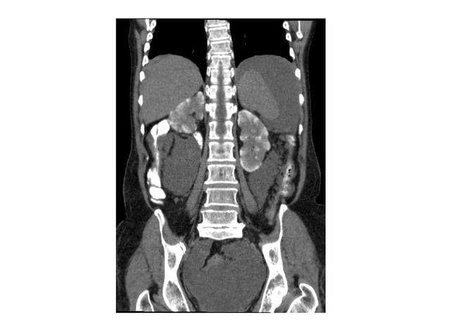 Diagnotic Imaging of Nephrocalcinosis | PPT