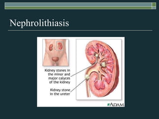 Nephrolithiasis | PPTX