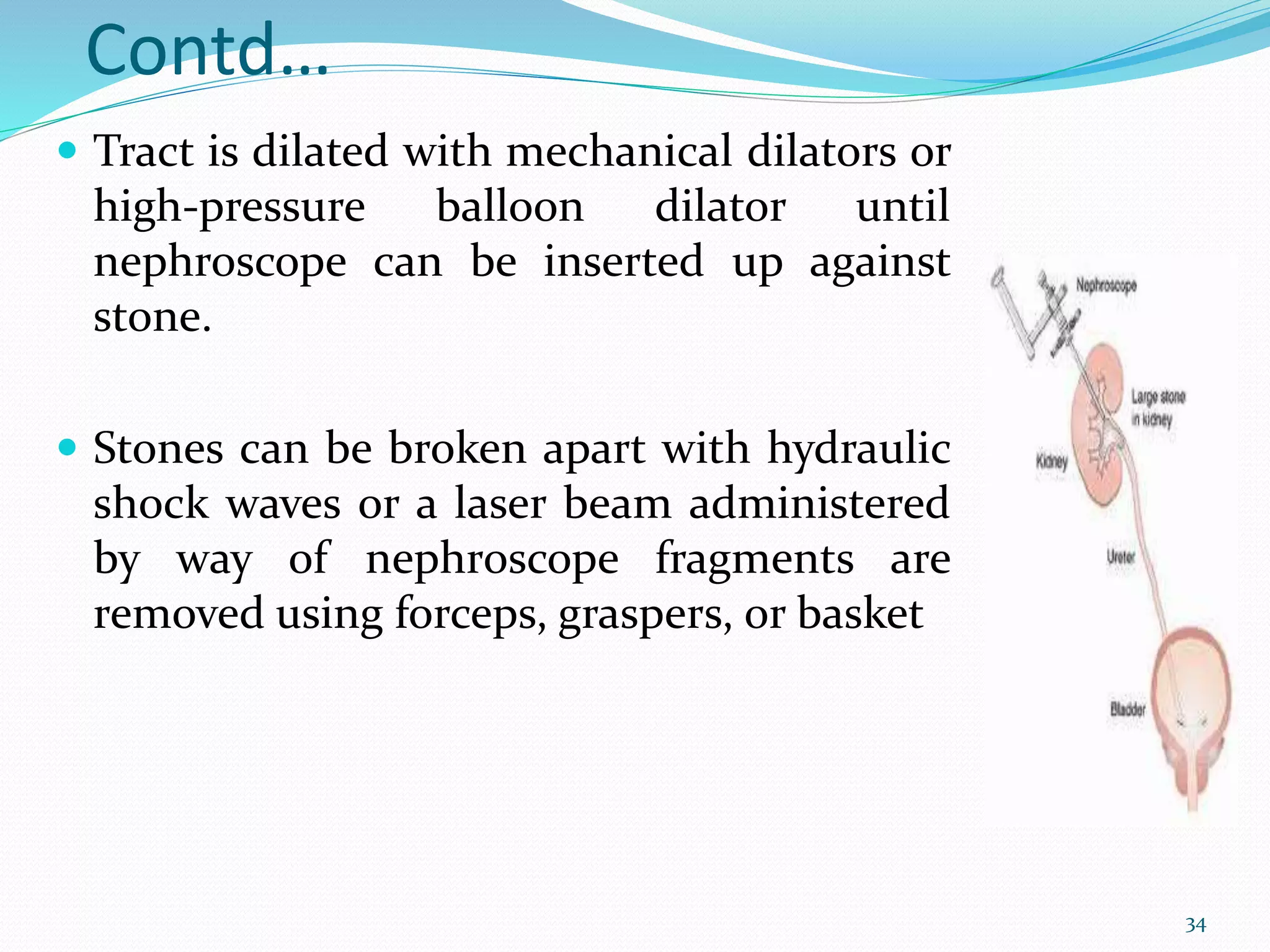 Nephrolithiasis | PPTX