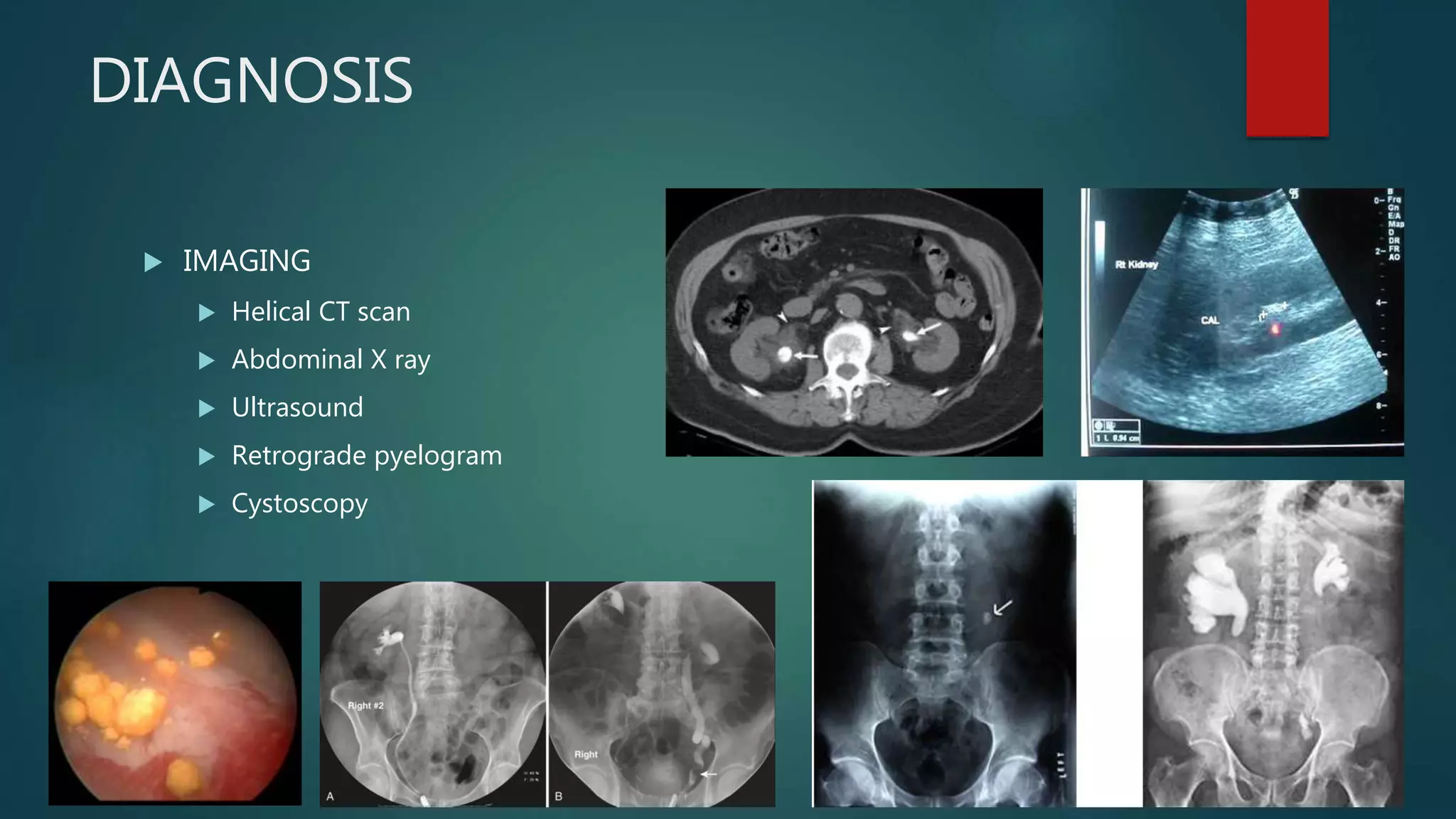 Nephrolithiasis and Pyelonephritis | PPTX