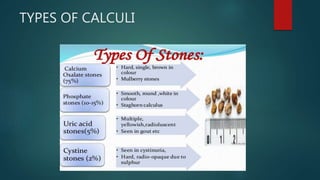 Nephrolithiasis and Pyelonephritis | PPTX