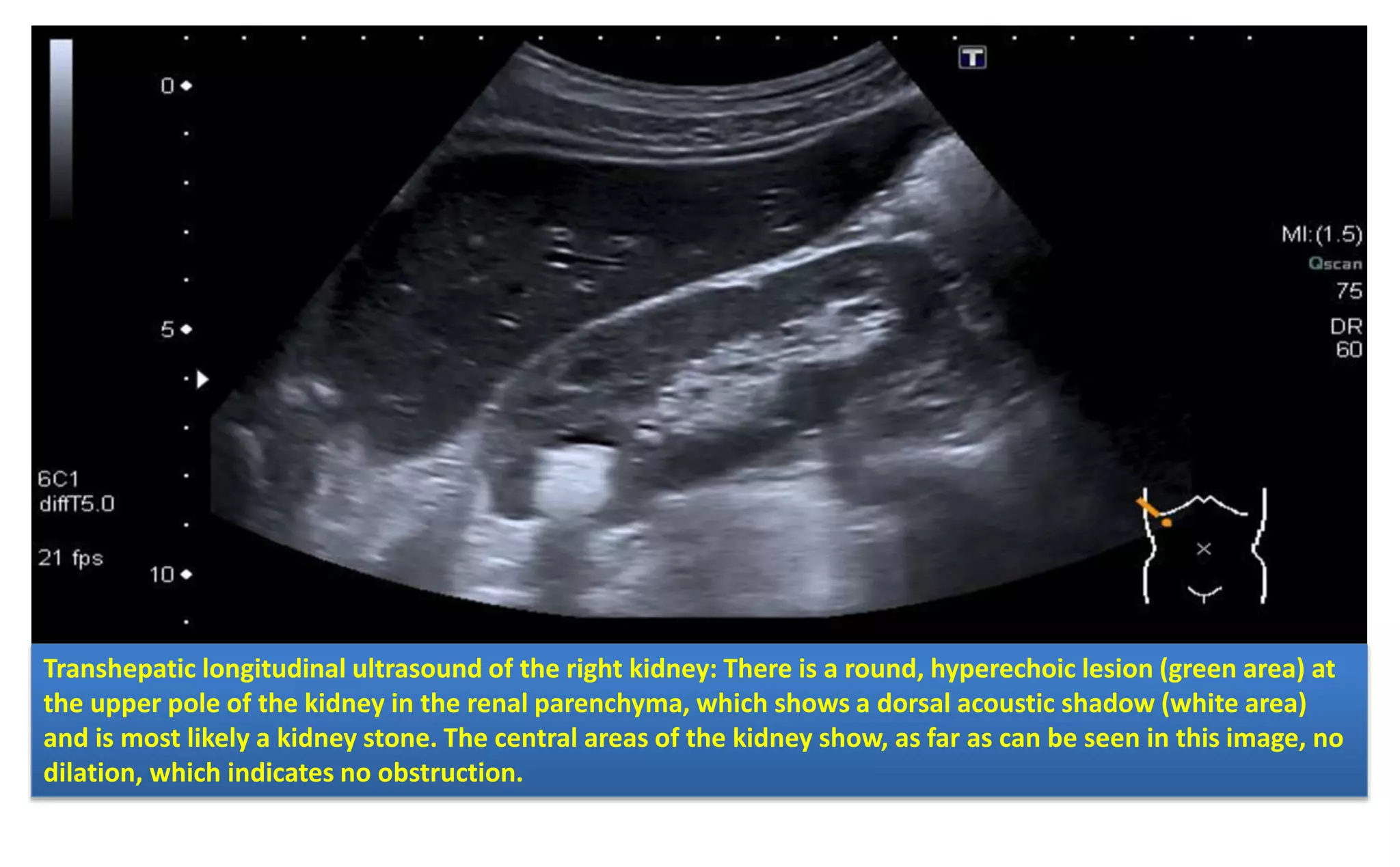 Nephrolithiasis - urinary stones | PPTX