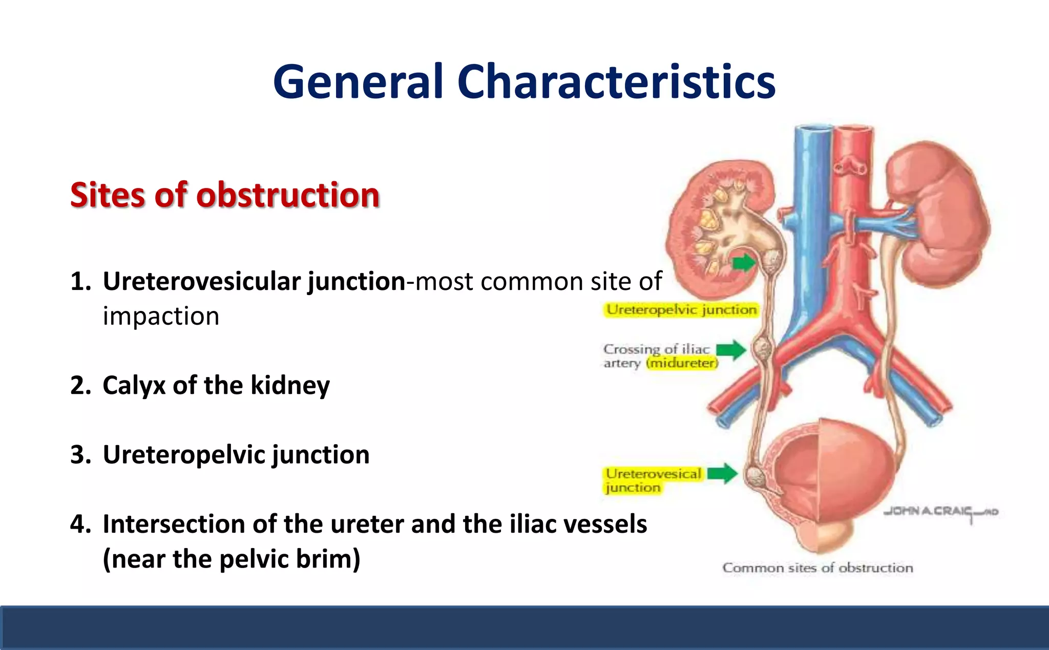 Nephrolithiasis - urinary stones | PPTX