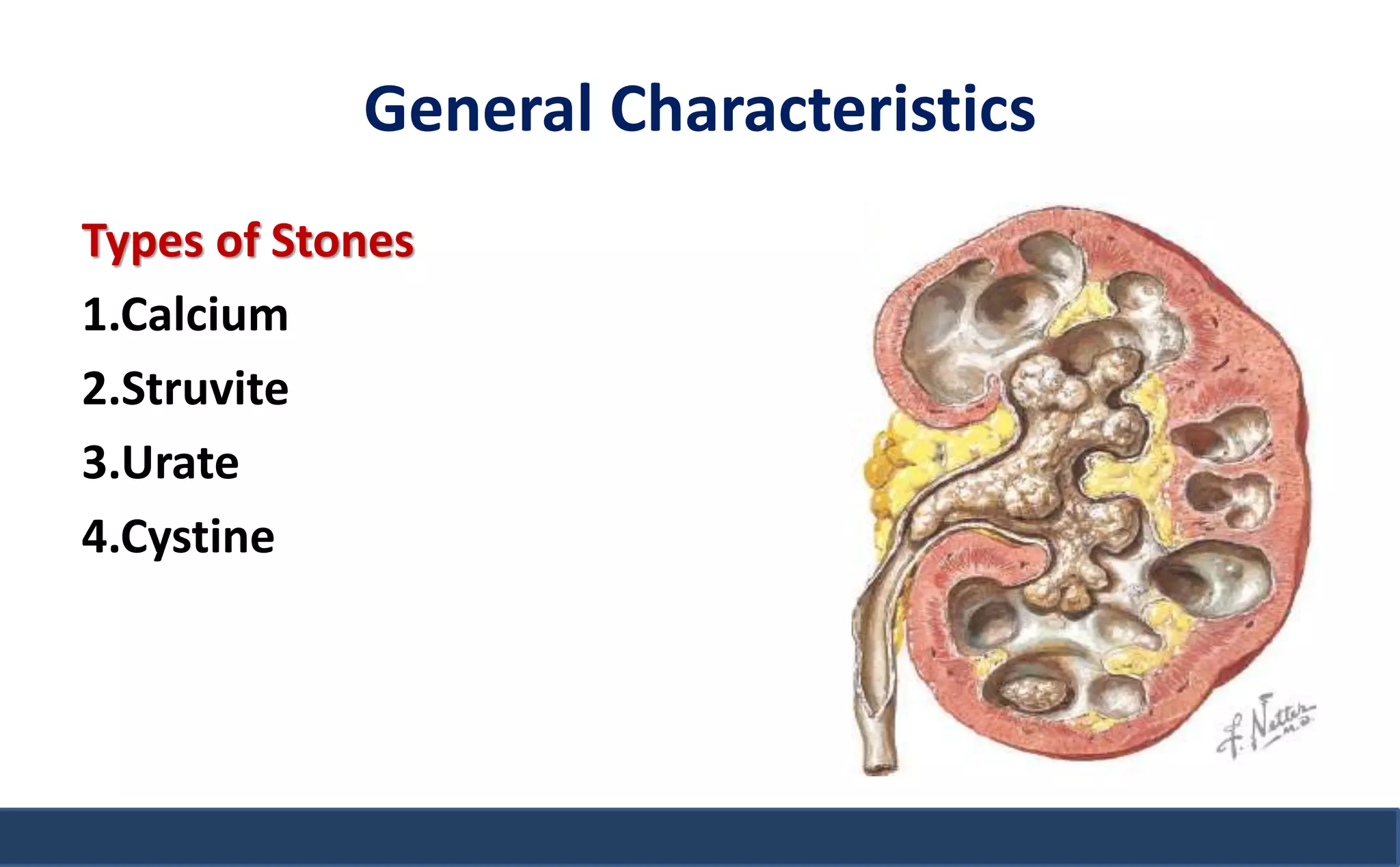Nephrolithiasis - urinary stones | PPTX