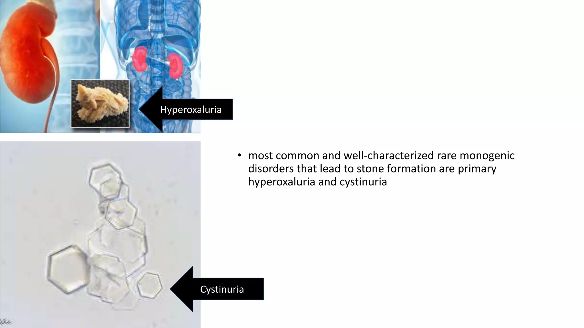 Nephrolithiasis_SHISODIA.pptx.pptx