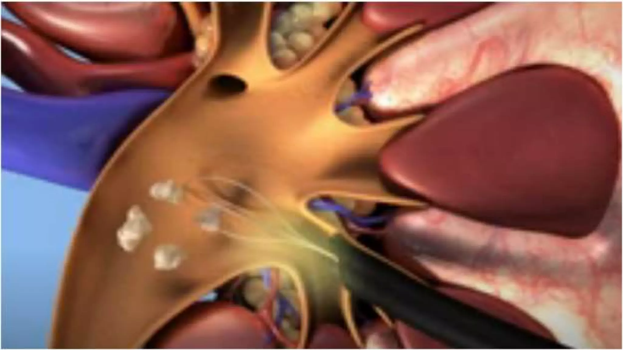 Nephrolithotomy | PPTX
