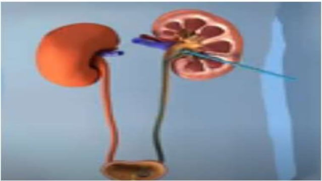 Nephrolithotomy | PPTX | Surgery | Medical Health