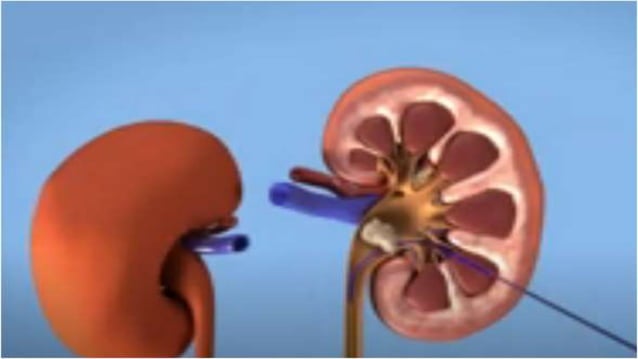 Nephrolithotomy | PPTX | Surgery | Medical Health