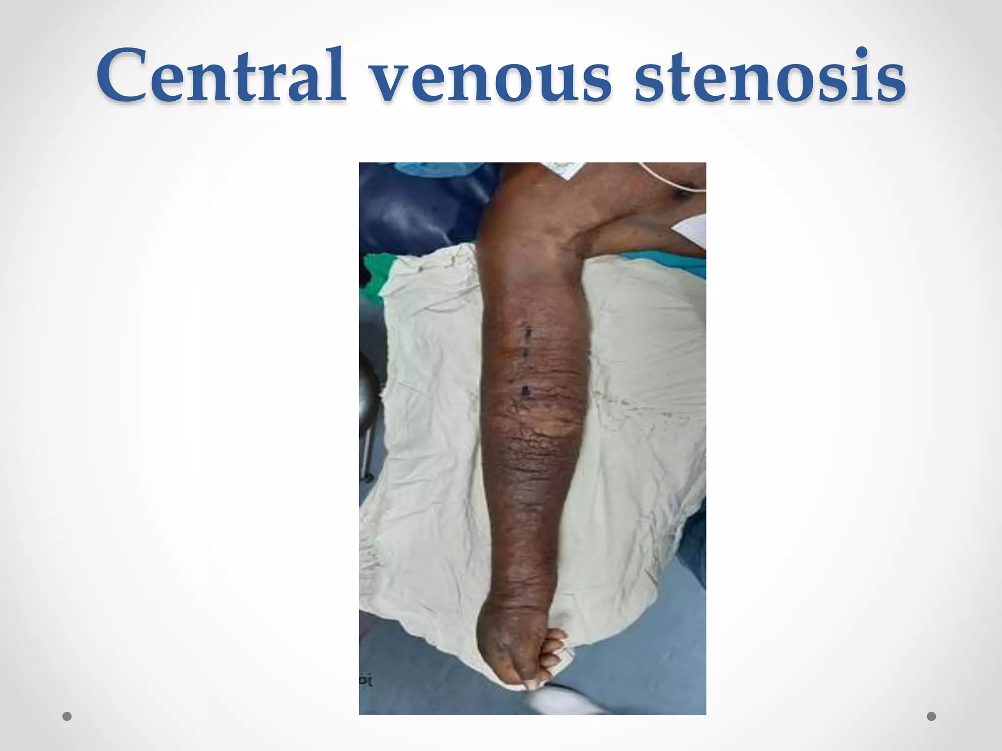 Vascular access Complications Surveillance / Troubleshooting | PPT