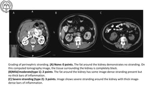 Nephrometry | PPTX