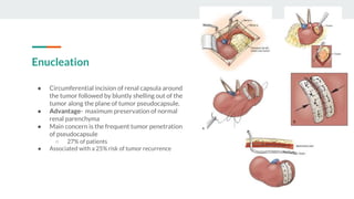 Nephron sparing Surgery.ppt,,,,,,,,,,,,,,,,,,,,,,,,,,,,,x | PPTX