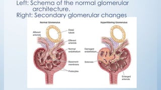 Chronic Kidney Disease, CKD, Nephrology, | PPTX