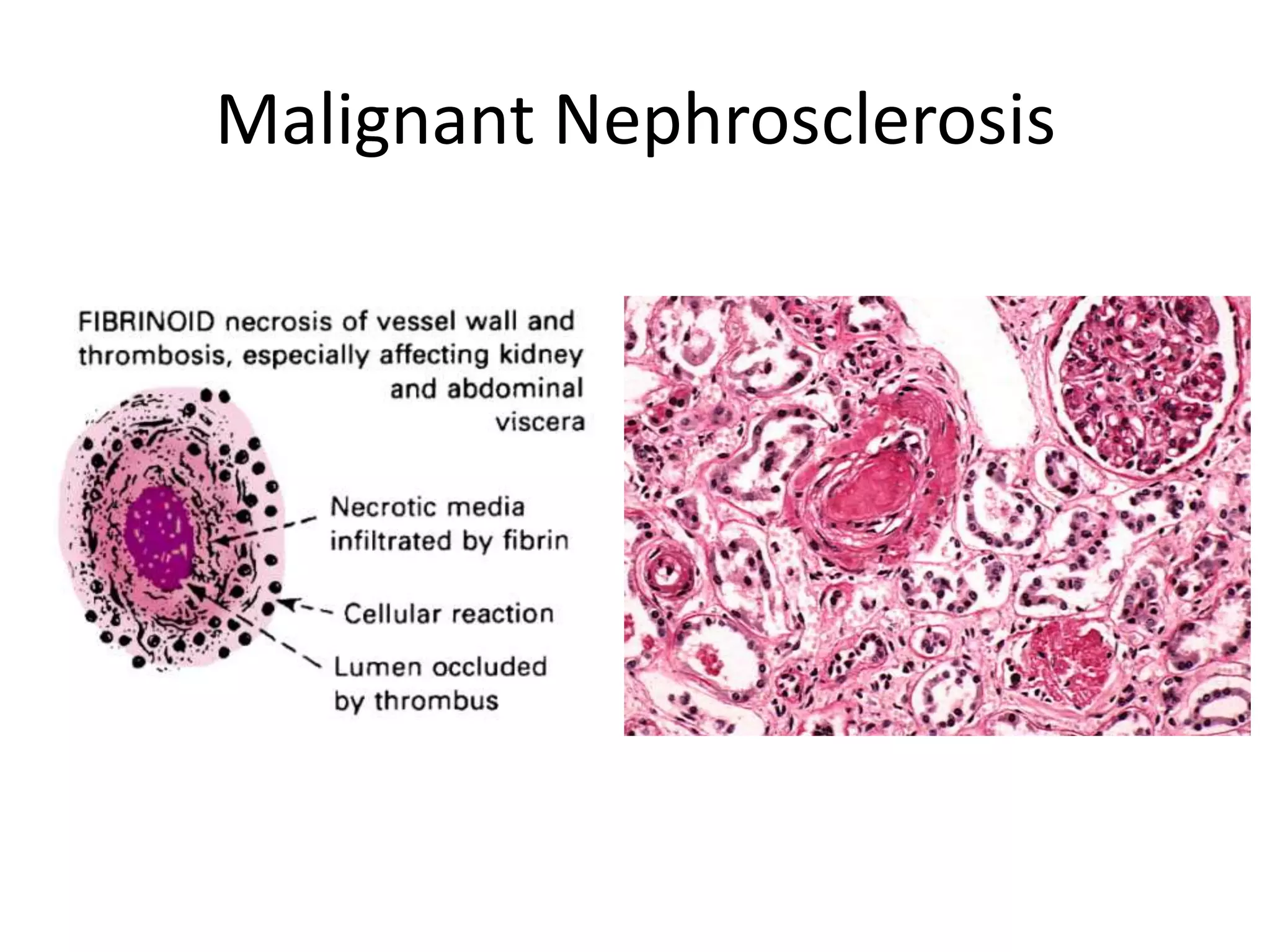 Nephrosclerosis | PPTX