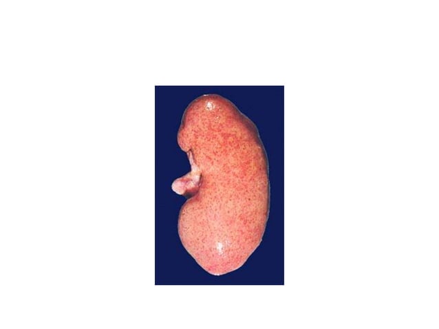 Nephrosclerosis | PPTX