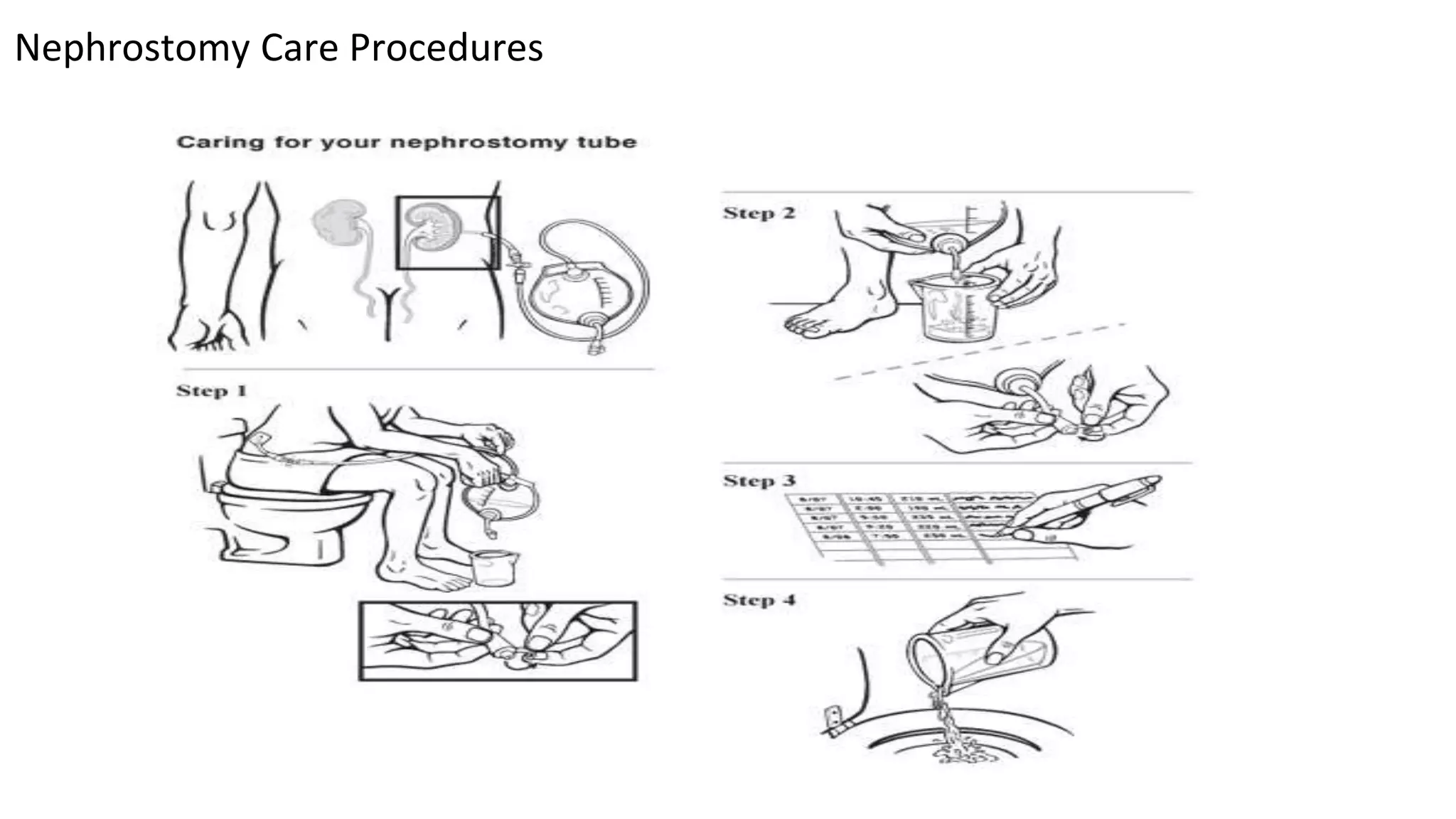 Nephrostomy tube eduaction for patiens | PPTX