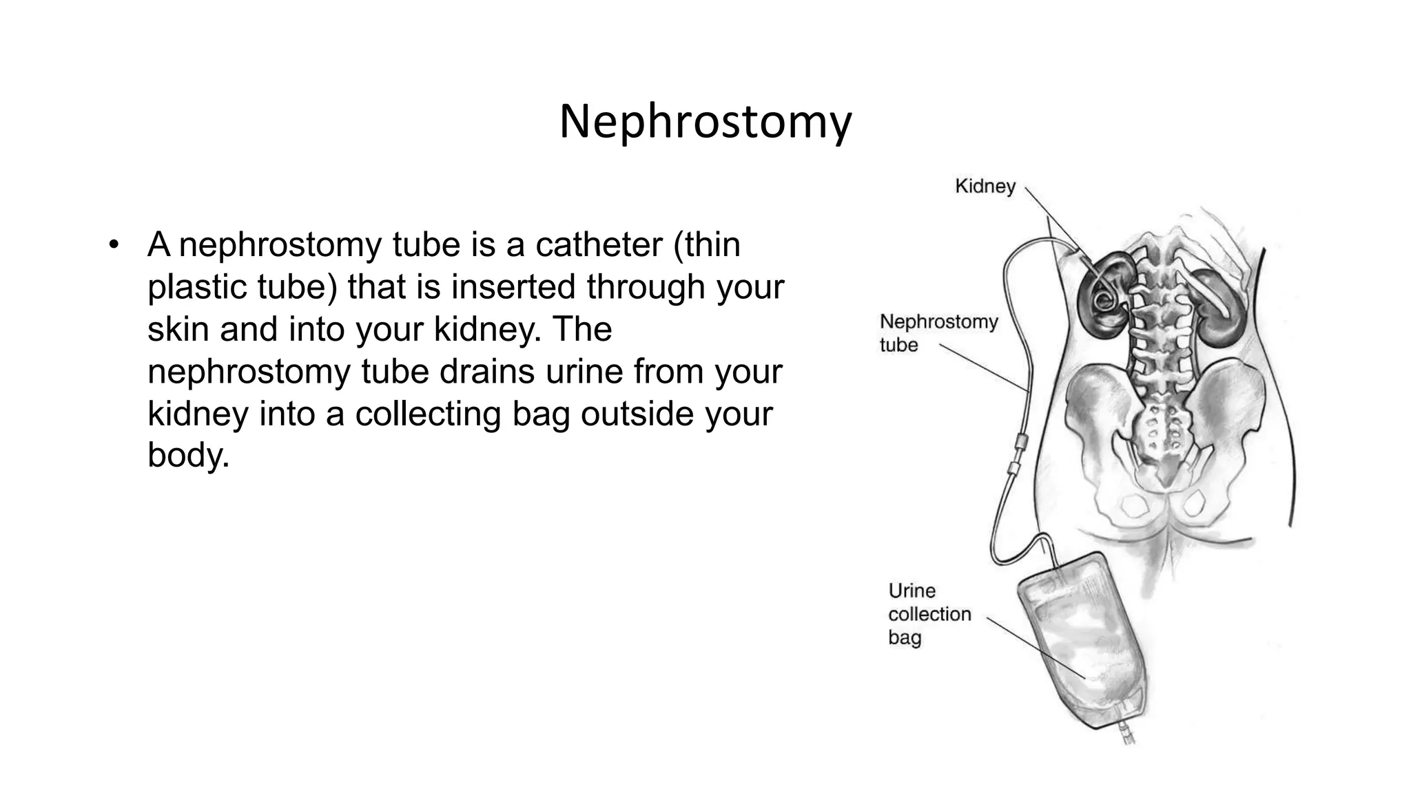 Nephrostomy tube eduaction for patiens | PPTX