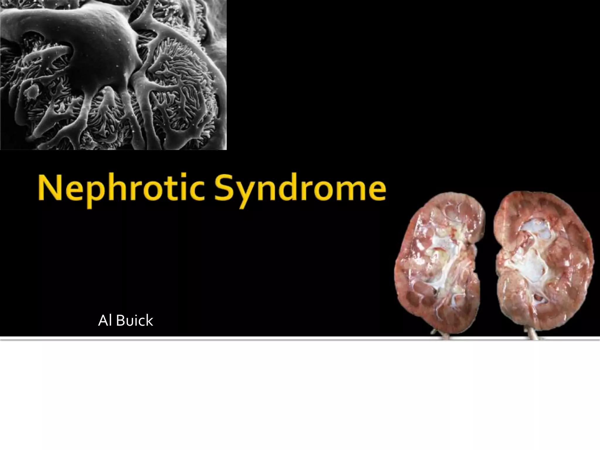 Nephrotic syndrome | PPTX