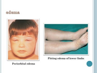 Periorbital Edema Nephrotic Syndrome