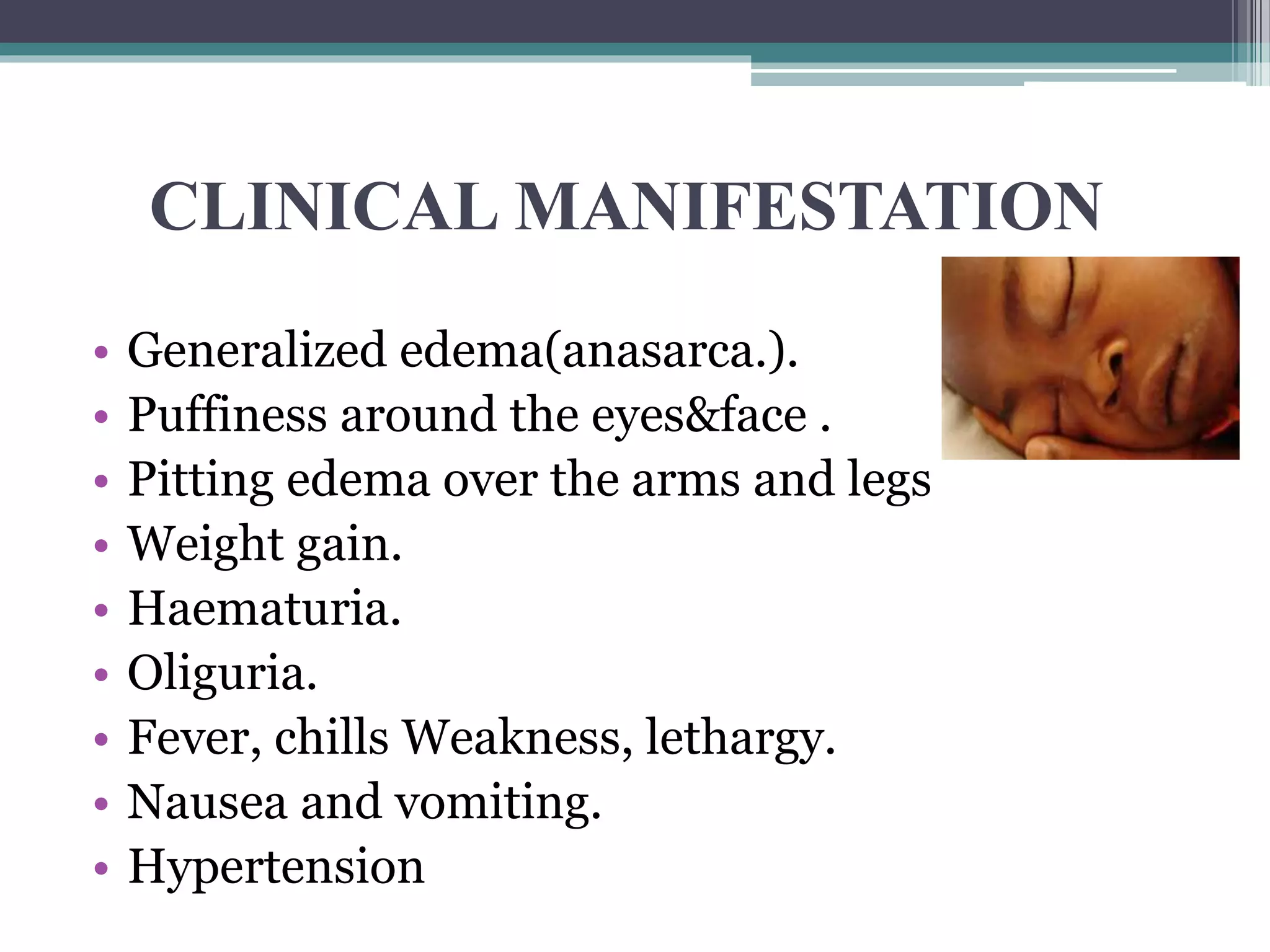 Nephrotic syndrome By Sachin Dwivedi | PPTX