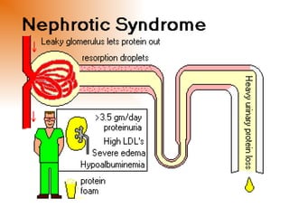 Nephrotic syndrome | PDF | Diseases and Conditions | Medical Health