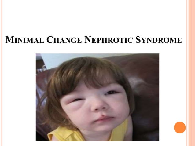 Nephrotic syndrome | PPT | Free Download
