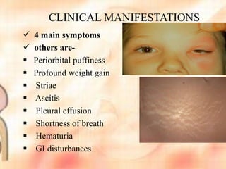Periorbital Edema Nephrotic Syndrome