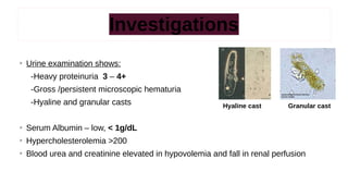 Nephrotic syndrome, Characterized by heavy proteinuria>3.5g/m/day in ...