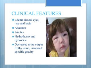 Nephrotic syndrome | PPTX