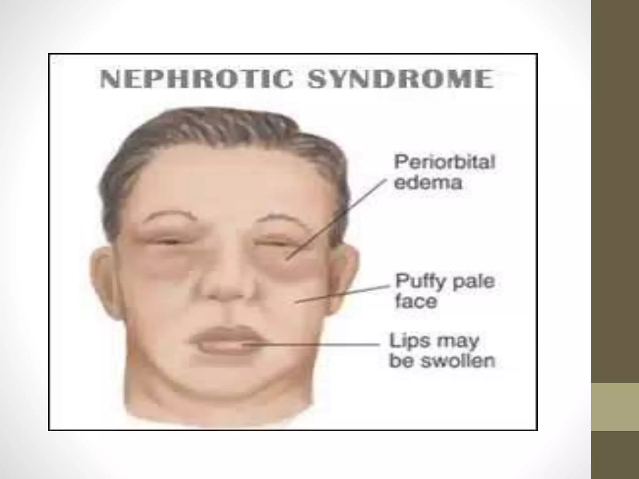 Nephrotic Syndrome.pptx